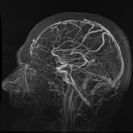 Magnetic Resonance Angiography (MRA)